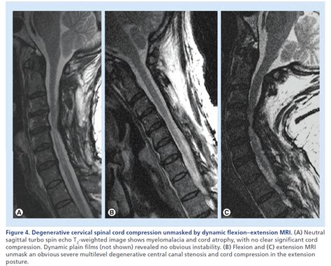 Spinal Cord Compression