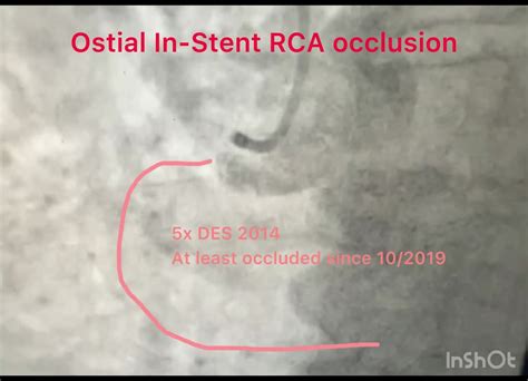 🚨 Cto Week 🫀 Rca In Stent Ostial Cto Via Retro And Antegrade Wire… Sebastian Bader