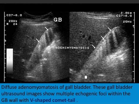 Focal Vs Diffuse Gall Bladder Wall Thickening