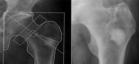 Osteoporosis X Ray Femur