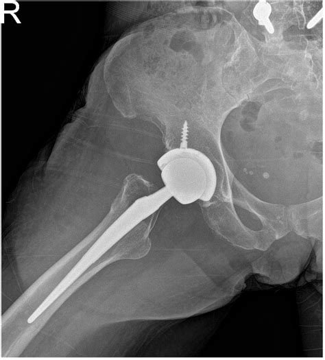 Case Study Bilateral Total Hip Replacement In 65 Year Old
