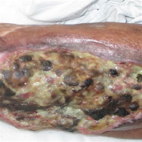 Histopathological Finding Of Pyoderma Gangrenosum Download Scientific Diagram