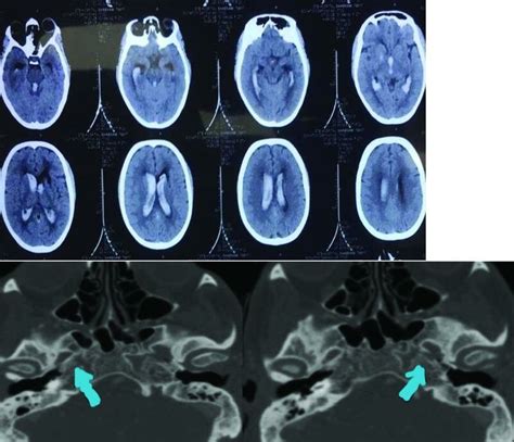 computed tomographic brain showing extensive intraventricular