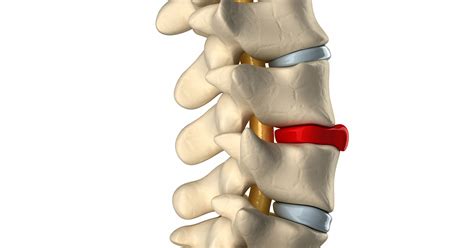 How Successful Is Total Disc Replacement Surgery Microspine Plc