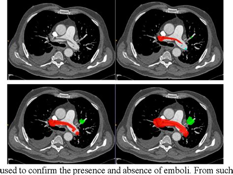Figure 2 From Computer Aided Detection For Pulmonary Embolism Challenge