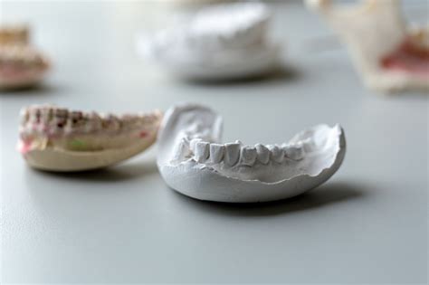 연구 진단 캐스트 및 치과 실험실에서 치과 석고 모델의 캐스팅 개방교합에 대한 스톡 사진 및 기타 이미지 개방교합 건강