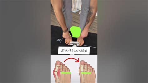 يوصي أخصائي العظام والمفاصل بهذا الإجراء لإصلاح انحراف اصبع القدم