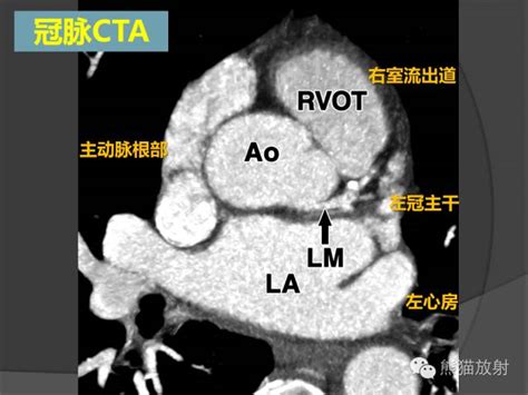 精彩推荐：冠状动脉系统解剖、cta解剖、分段及中英文名称对照 Medsci Cn