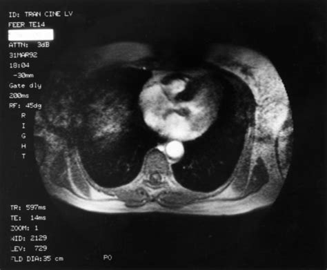 Fibroelastoma Case Report And Review Of The Literature Pmc