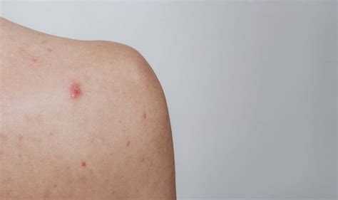 Cara Mengatasi Bisul Dengan Cepat Obat Salep Dan Panduannya