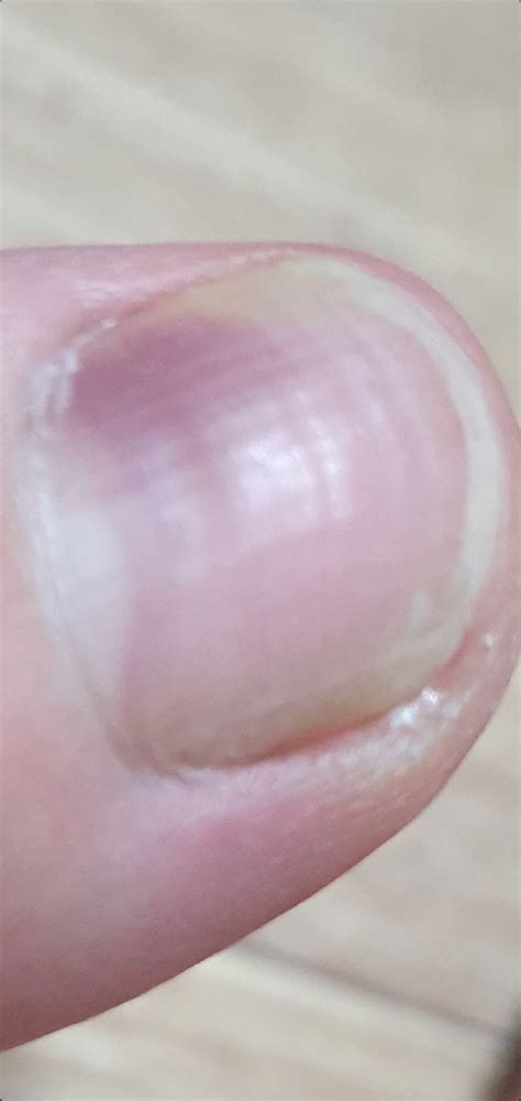 발톱 멍 이정도면 병원가서 뚫는치료 해야할까요 지식in