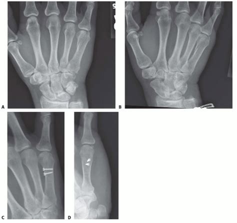 Operative Treatment Of Metacarpal Fractures Musculoskeletal Key