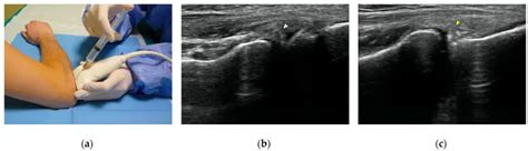 Ct Arthrography Of Elbow