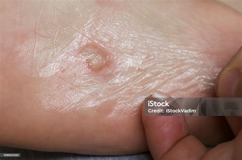 Dyshidrotic Eczema On The Foot Blister Dermatitis It Is Treated With