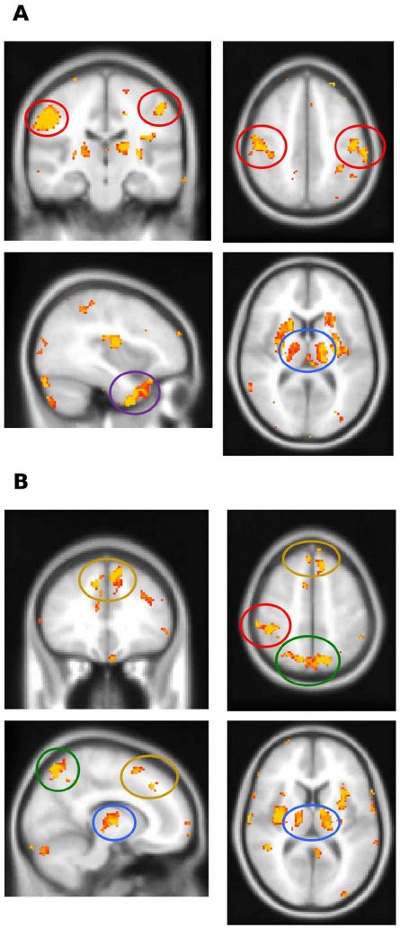 Voxel Based Morphometry Analysis With The Apraxia Score As A Covariate Download Scientific