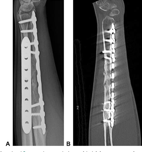 Figure 2 From Masquelet Technique For Treatment Of Segmental Bone Loss In The Upper Extremity