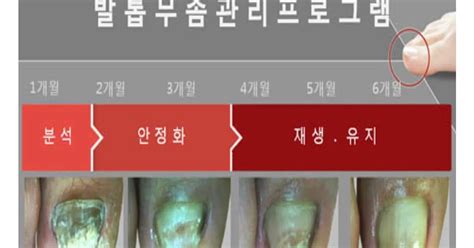 발톱무좀 김솔지 숨고 숨은고수