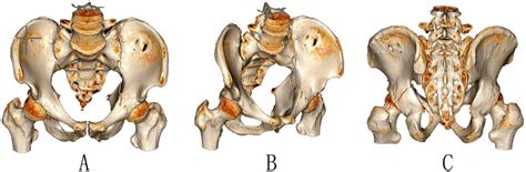 Three Dimensional Ct Of The Pelvis Showing Transverse Acetabular