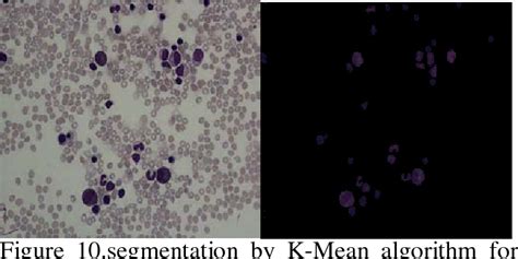Figure 1 From Tumor Detection Using K Mean Clustering Algorithm Method