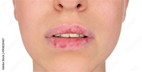 Picking Lips Disorder Lipstutorial Org