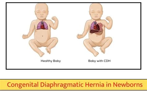 Congenital Diaphragmatic Hernia In Newborns Dr Shalil Patil