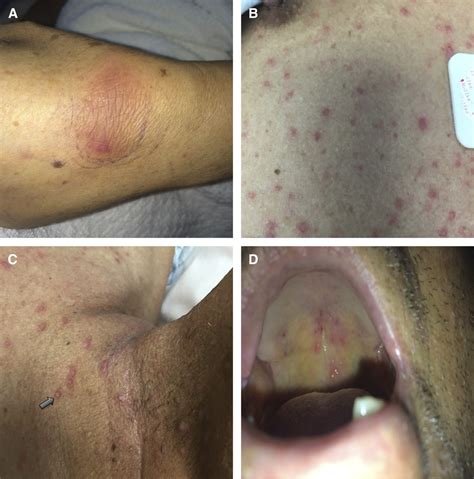 Histoplasmosis Skin