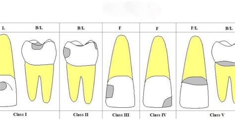 Nomenclatura E Partes Constituintes Das Cavidades Odontoup