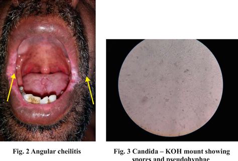 Angular Cheilitis Hiv