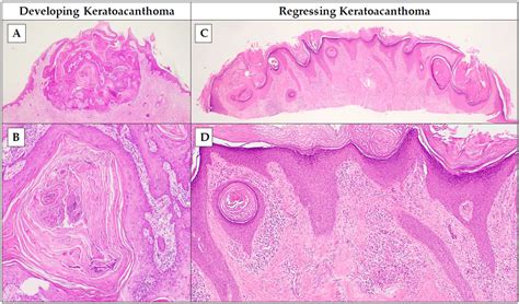 Keratoacanthoma Versus Squamous Cell Carcinoma Histopathological