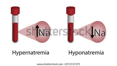Hypernatremia High Plasma Sodium Level Hyponatremia Stock Vector