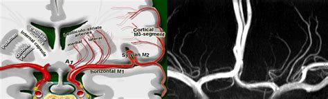 Arterial Territories Of The Brain Stroke Manual