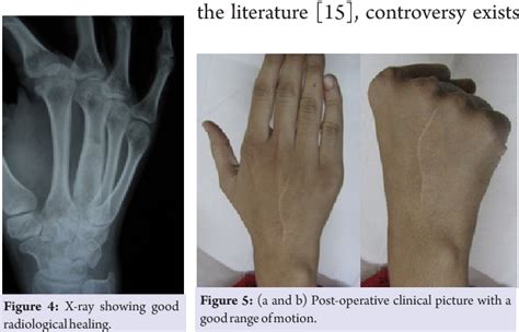 [pdf] Aneurysmal Bone Cyst Of 3rd Metacarpal Management And Follow Up A Case Report Semantic