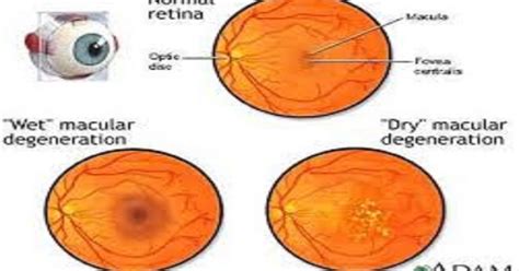 Types Of Eye Diseases To Know Infodasar Com
