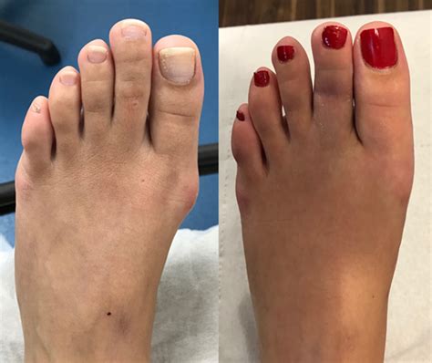 Toe Shortening Surgery