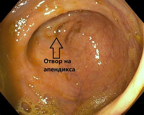 Нормален образ на сляпото черво цекум Д р Стефан Митев