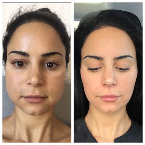 How Much Does Masseter Botox Cost