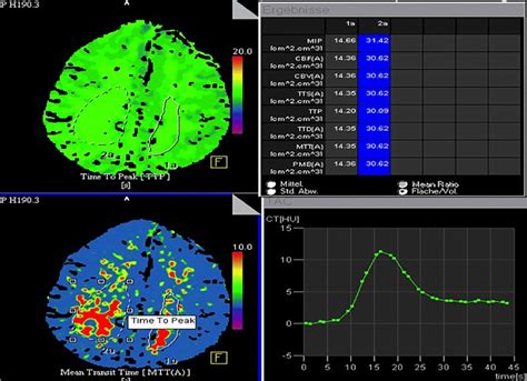 Quantitative Analysis Of Ctp Parameters Download Scientific Diagram