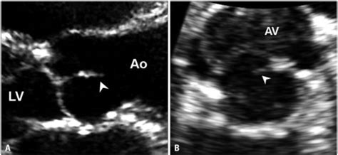 Lambls Excrescence In Parasternal Long A And Short Open I
