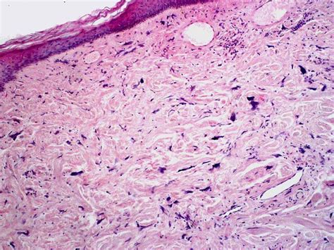 Pleomorphic Fibroma Alchetron The Free Social Encyclopedia