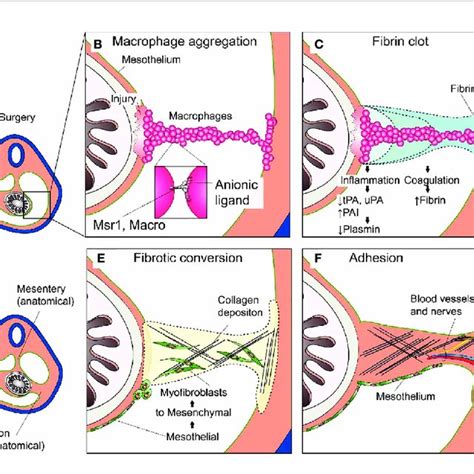 Post Surgical Adhesion Formation A Overview Of The Peritoneal