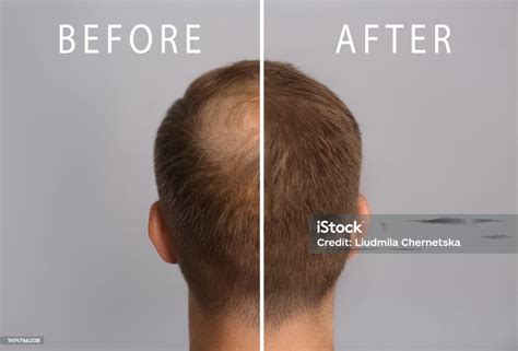 회색 배경 콜라주에 치료 전후에 탈모 문제가있는 남자 방문 Trichologist 머리가 빠지다에 대한 스톡 사진 및 기타 이미지 머리가 빠지다 털 남자 Istock