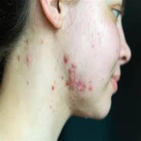 Acne Detection Yolov9 Object Detection Dataset And Pre Trained Model By