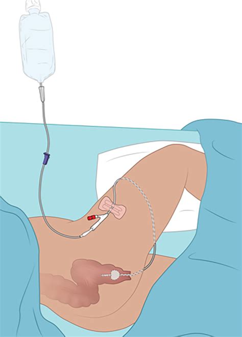 Proctoclysis Via The Macy Catheter Hospi Corporation Download