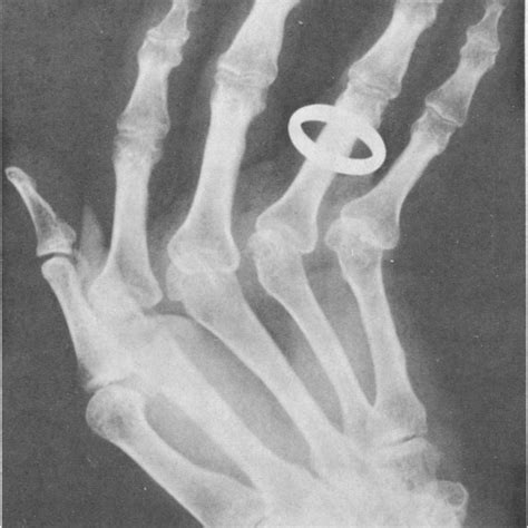 Postoperative X Ray Film Of Metacarpal Phalangeal Joints After Download Scientific Diagram