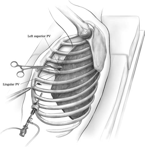 Minimally Invasive Segmentectomy Operative Techniques In Thoracic And Cardiovascular Surgery