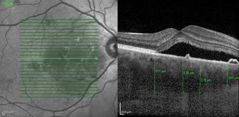 Central Serous Chorioretinopathy Cedar Rapids Csc Iowa City