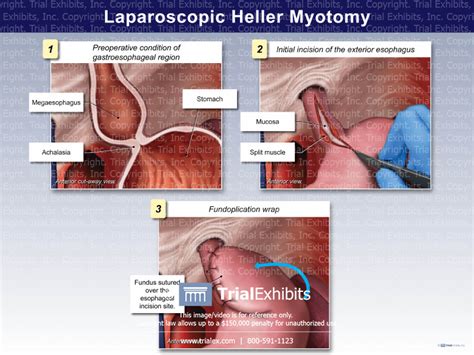 Laparoscopic Heller Myotomy
