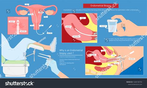 Endometrial Biopsy Examination Uterus Procedure Ivf Stock Vector