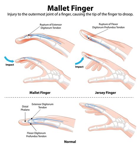 Free Vector Mallet Finger Injury Illustration
