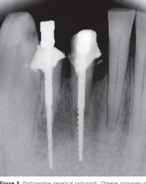 Endo Implants At Juanita Morris Blog